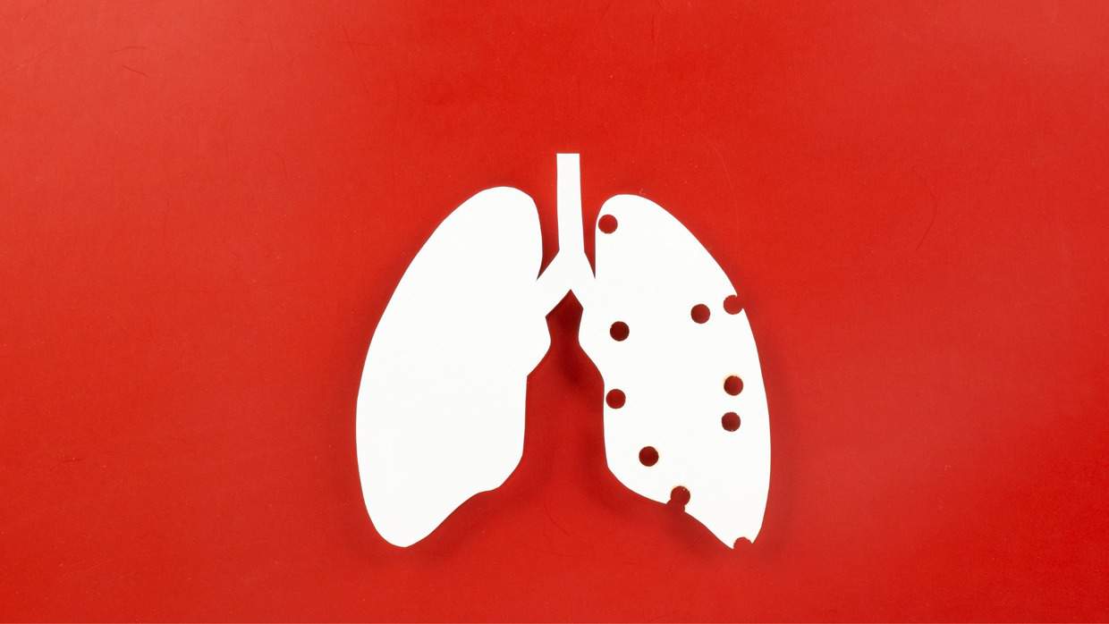 Tuberculosis: Why haven’t we eliminated TB yet?
